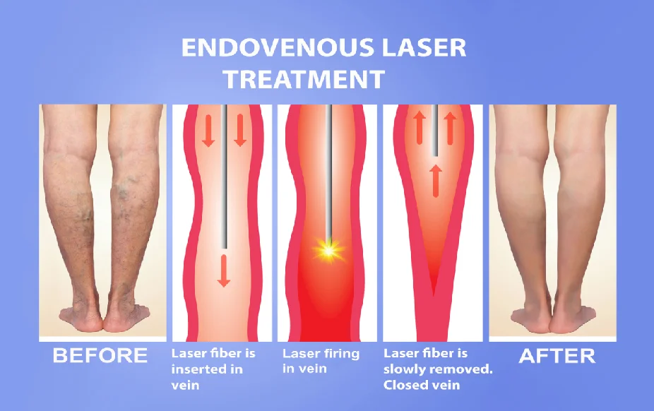 200um to 800um Endolaser Lipolysis Fibers for Varicose Veins