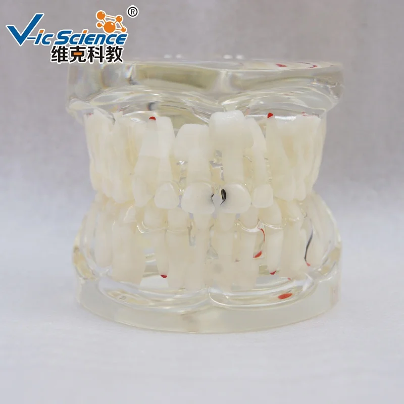 Anatomical Model Of Deciduous Permanent Teeth With Alternating Caries ...