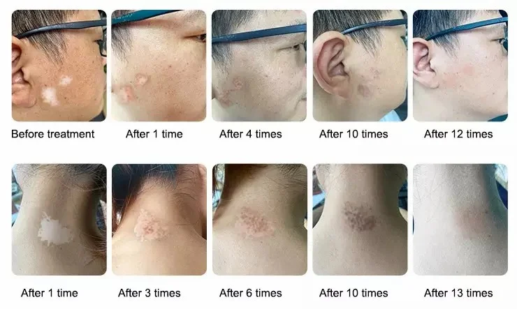 Kernel 311nm Uvb Phototherapy For Vitiligo Psoriasis Treatment With ...