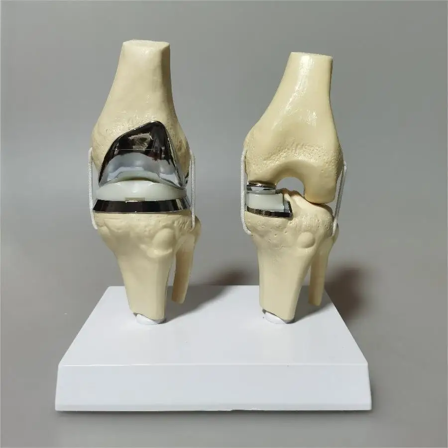 Artificial Knee Joint Replacement Teaching Display Model Human Knee ...