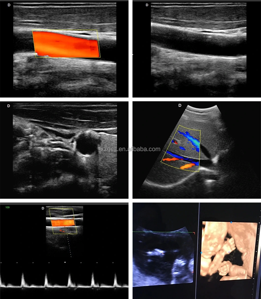 Ultrasonido Abdomen Convex Transvaginal Human Pregnancy Color Doppler ...