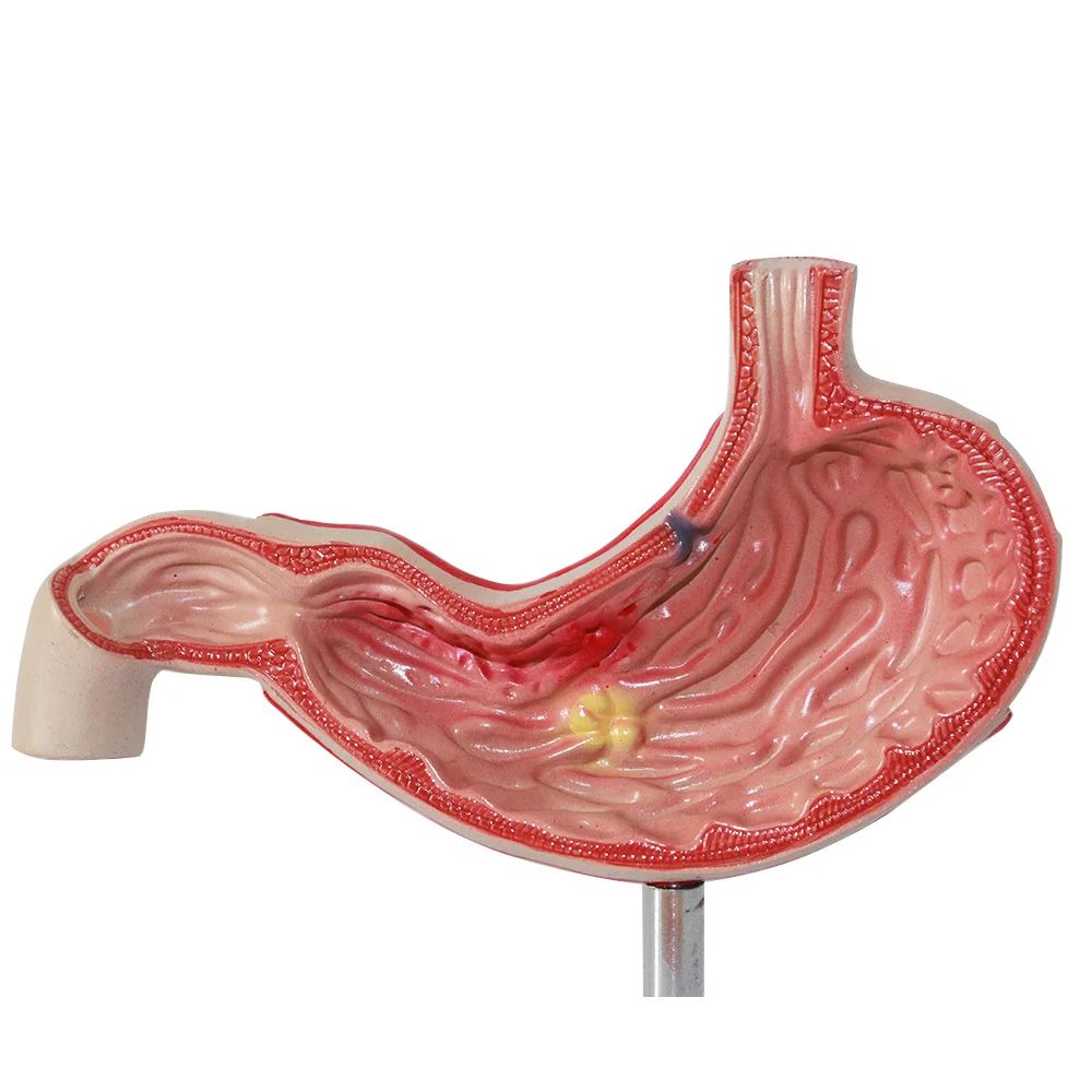 Anatomical Model of Chronic Pathological Gastritis & Ulcer