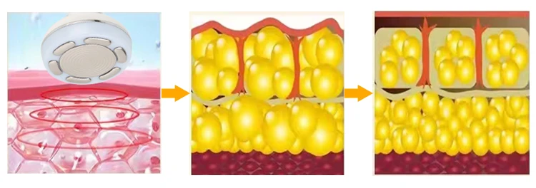 Japan 10in1 Radiofrequency Ret Cet Rf 448khz Skin Tightening Vacu ...