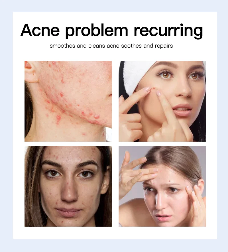 Private Label Skincare Hydrocolloid Acne Plaster Remove Acne Spot Acne ...