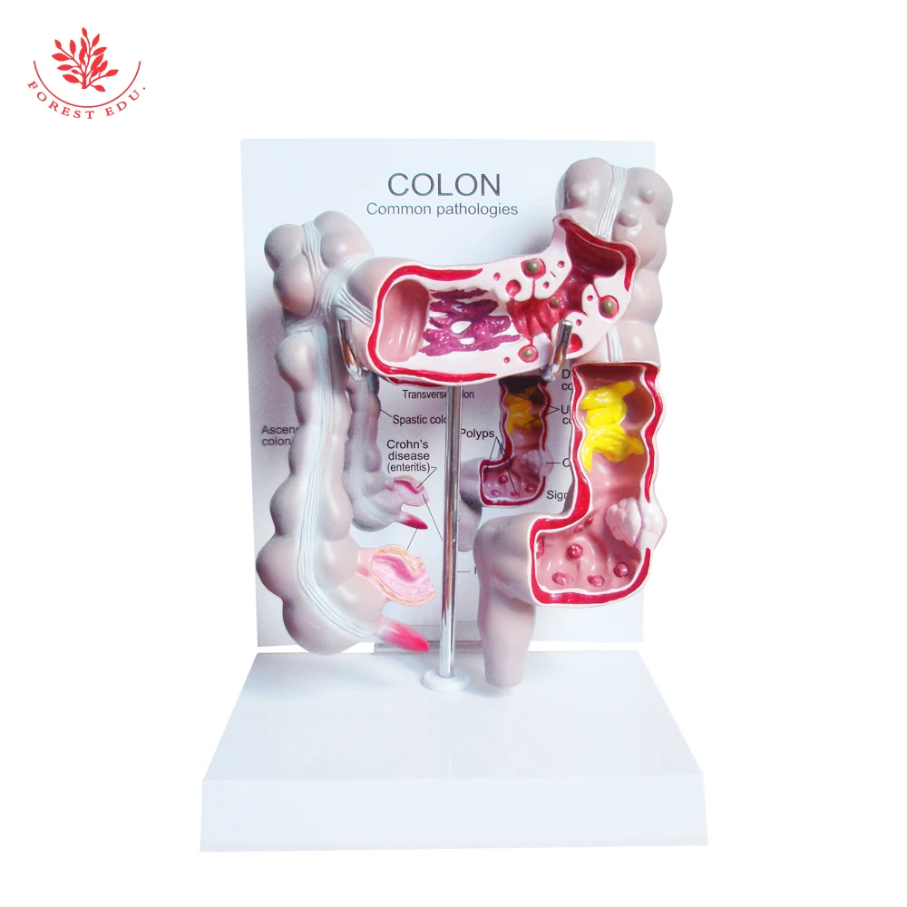 Colon Comprehensive Pathology Model Gastrointestinal System Pathology ...