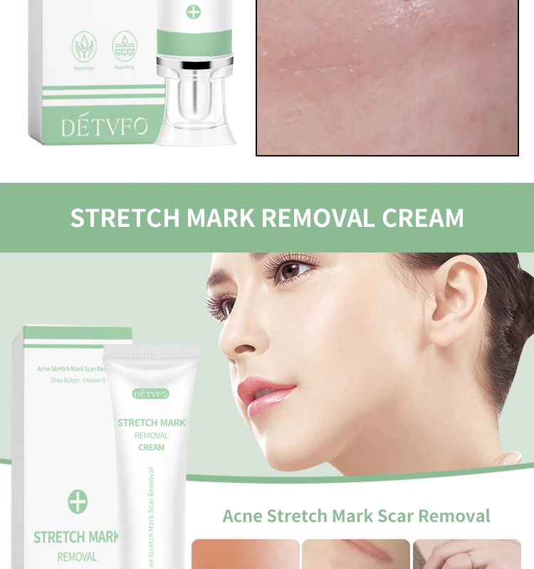 Strong Effective Acne Scar Removal Cream Pimples Stretch Mark Remove ...