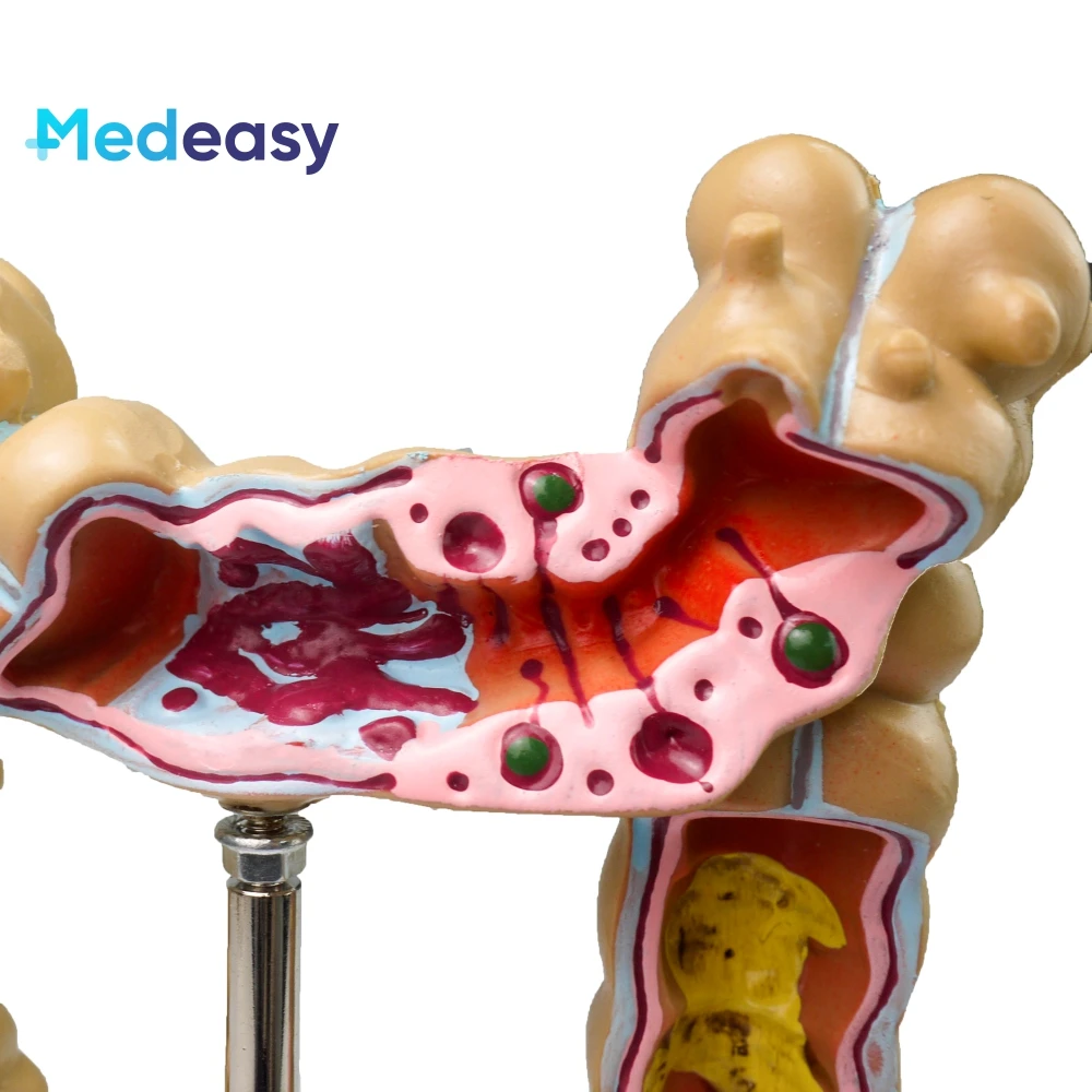 Human Colon Disease Model - Detailed Anatomical Teaching Tool