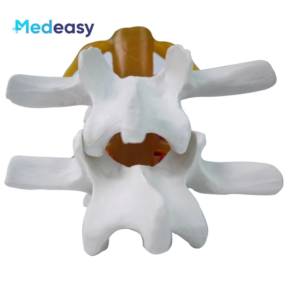 Lumbar Disc Herniation Model - Educational Anatomical Tool