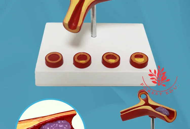 Artery and Blood Vessel Model - Understanding Atherosclerosis
