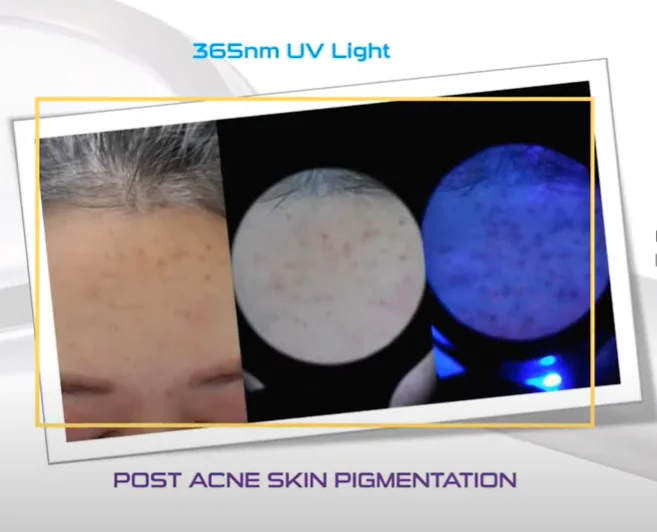 Facial Skin Analyzer with Wood Lamp - Medical Dermatology