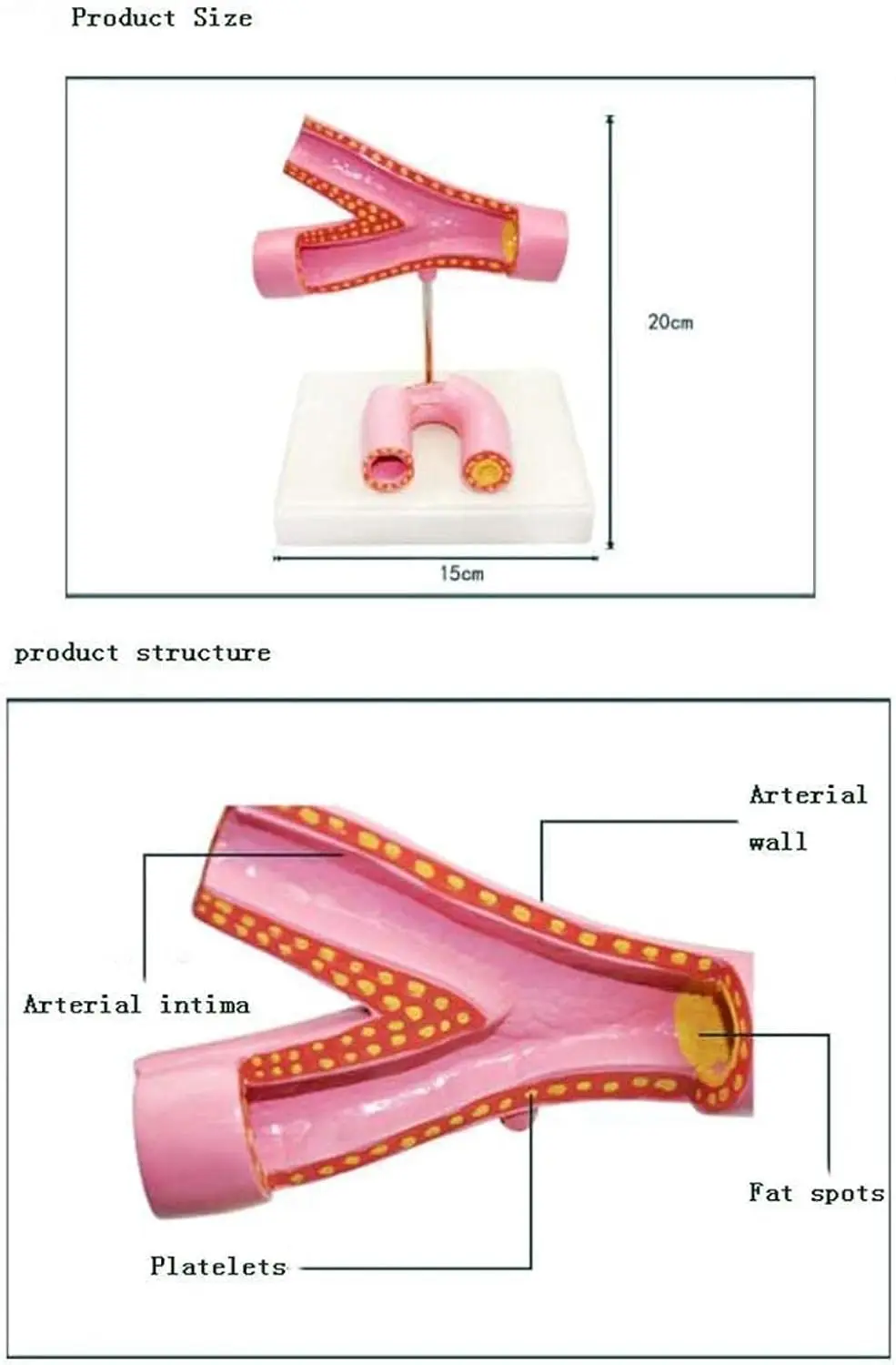 Anatomical Human Blood Vessel Model Arteriosclerosis Model With ...