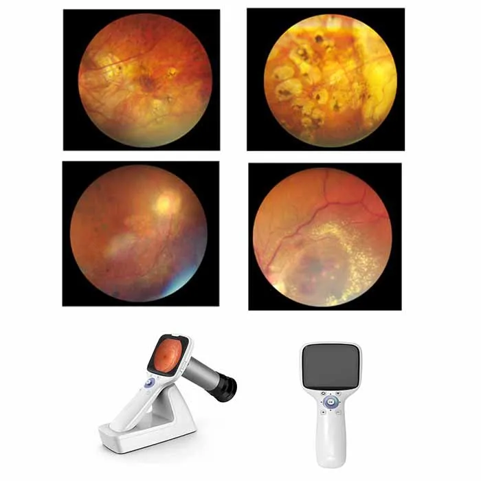 HFC-600 Handheld Fundus Camera - Portable Eye Retinal Scanner