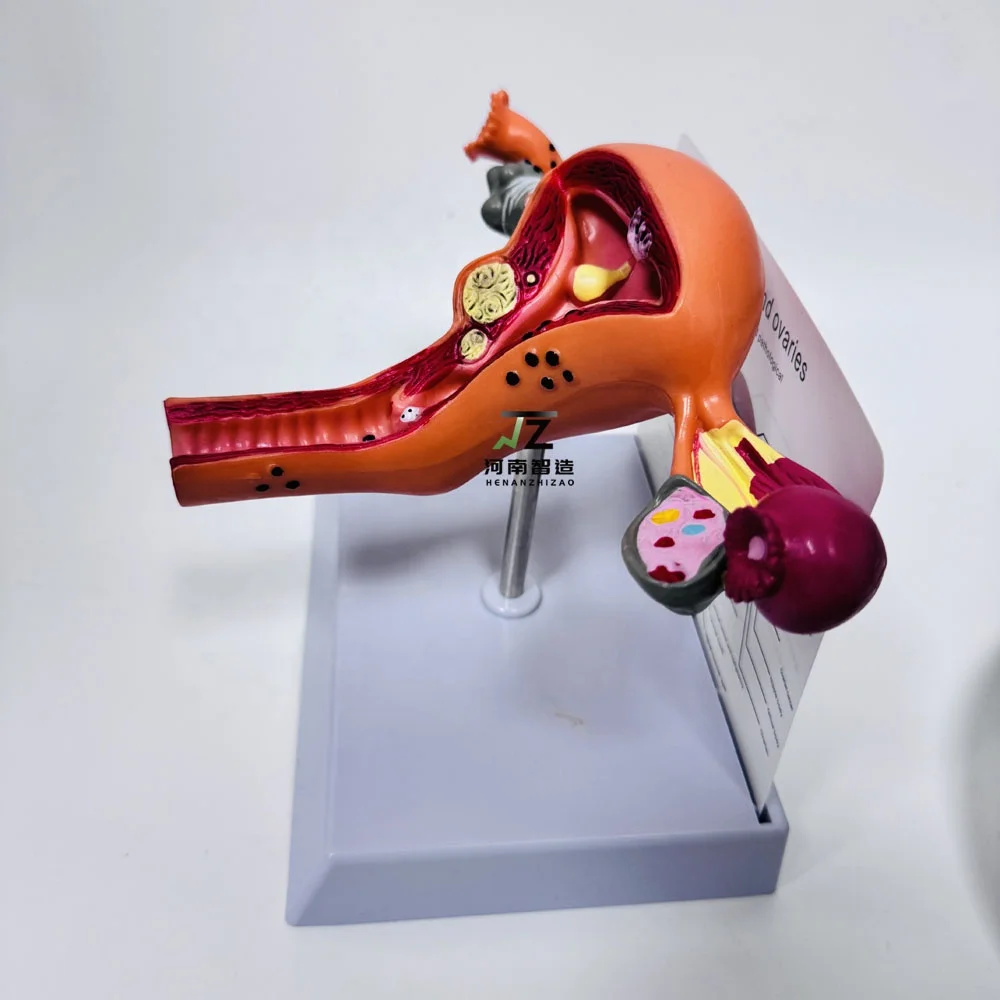 Pathological Model of Ovarian Uterus - Reproductive Medicine Gifts