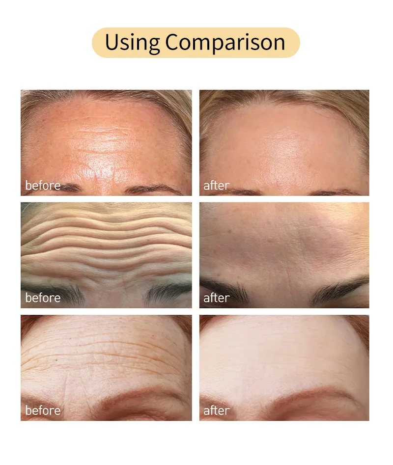 Beauty Skin Forehead Patch - Anti Wrinkle & Moisturizing