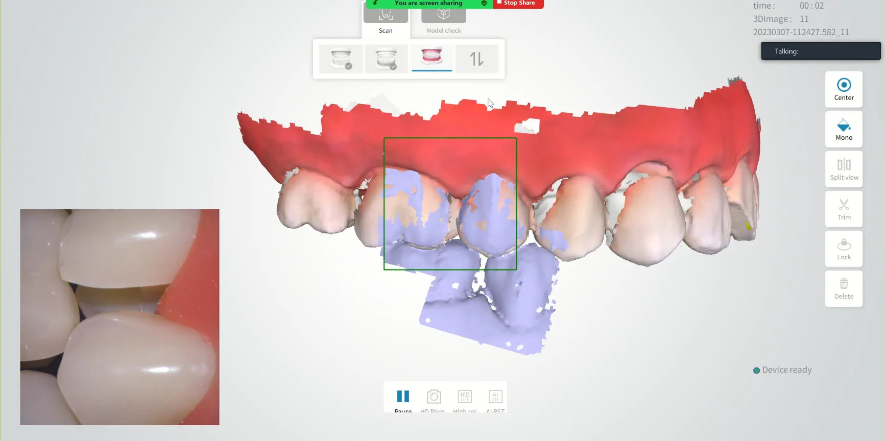 New Dental 3d Scanner Intraoral Trade Handheld Digital Dental 3d ...