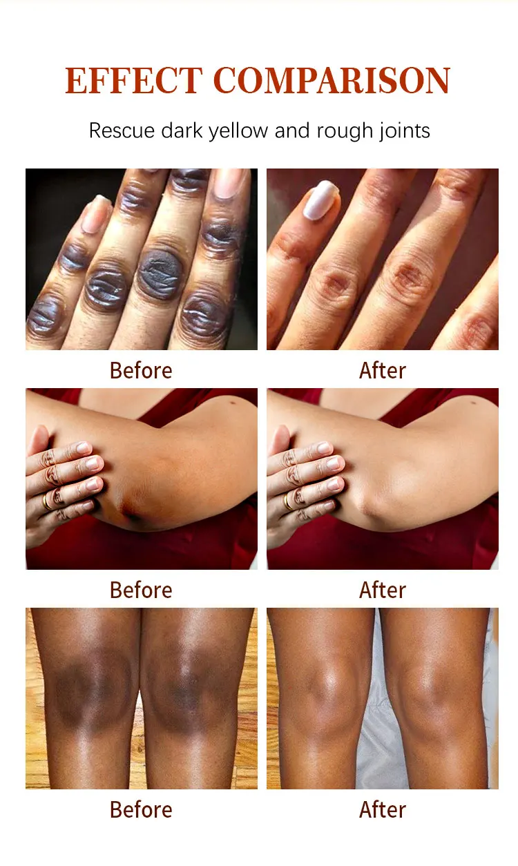 Dark Knuckles Fast Whitening Serum - Pigmentation Correctors