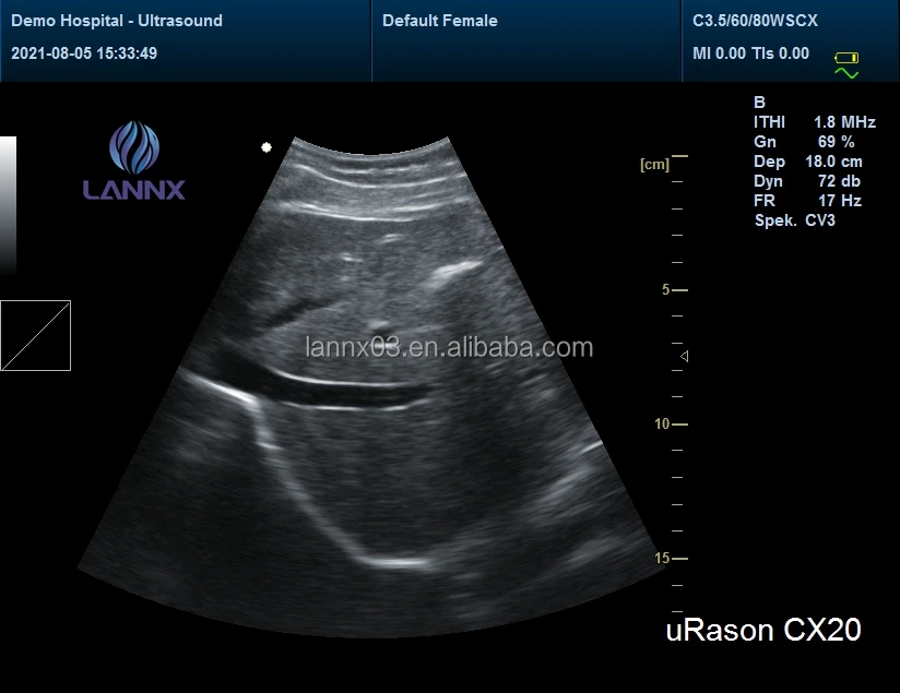 Lannx Urason Cx20 Hd Screen Laptop Digital Cardiology Ultrasound Medical 2d/3d Optional ...