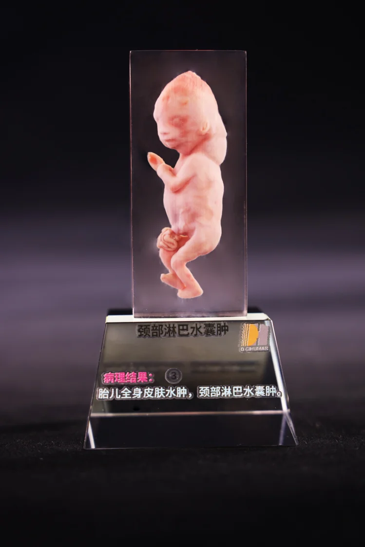 3D Printed Embryo Model of Malformed Embryos Embryology Learning for ...