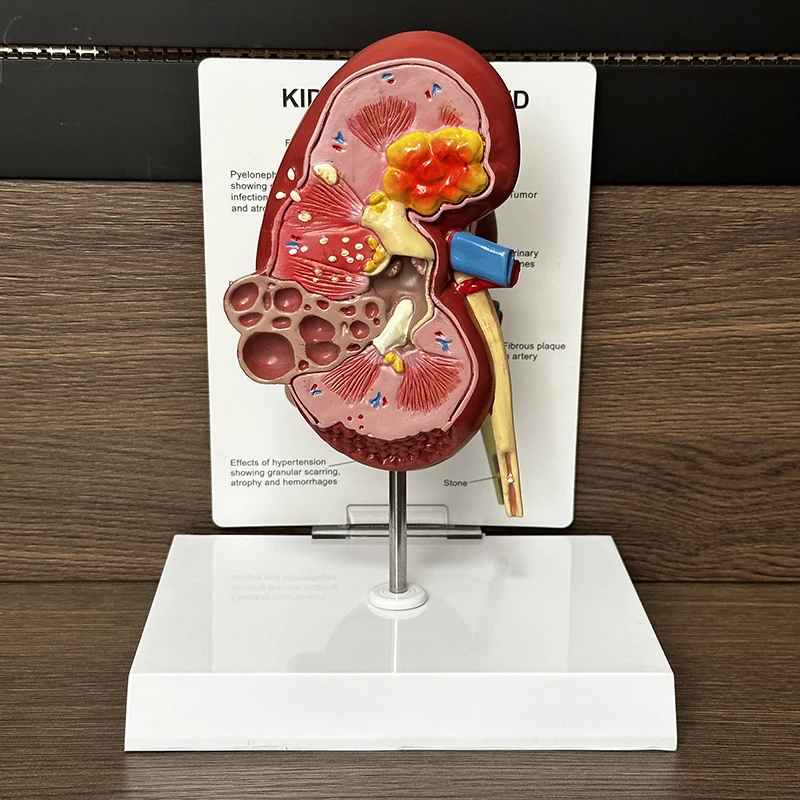 Life Size Diseased and Normal Kidney Anatomical Model Urinary System ...