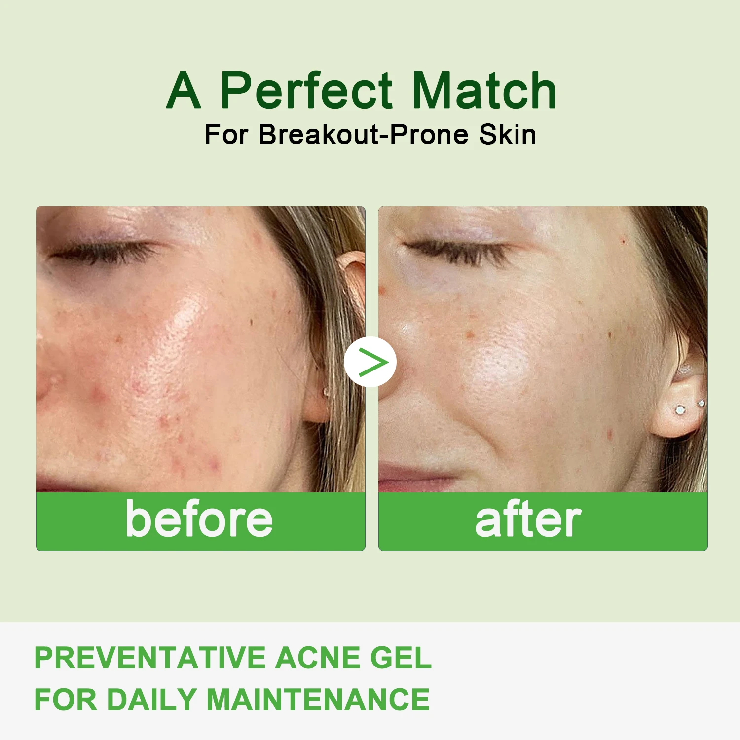 2% Salicylic Acid Acne Cream Fast Repair Barrier Face Pimple Gel for ...