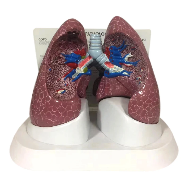 Medical Science Smoking Lung Display Model Healthy Lung Diseased Lung ...