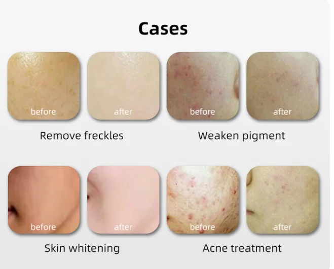 Pdt Light Therapy Mask 7 Color Phototherapy Pdt Facial Machine Jet Peel ...