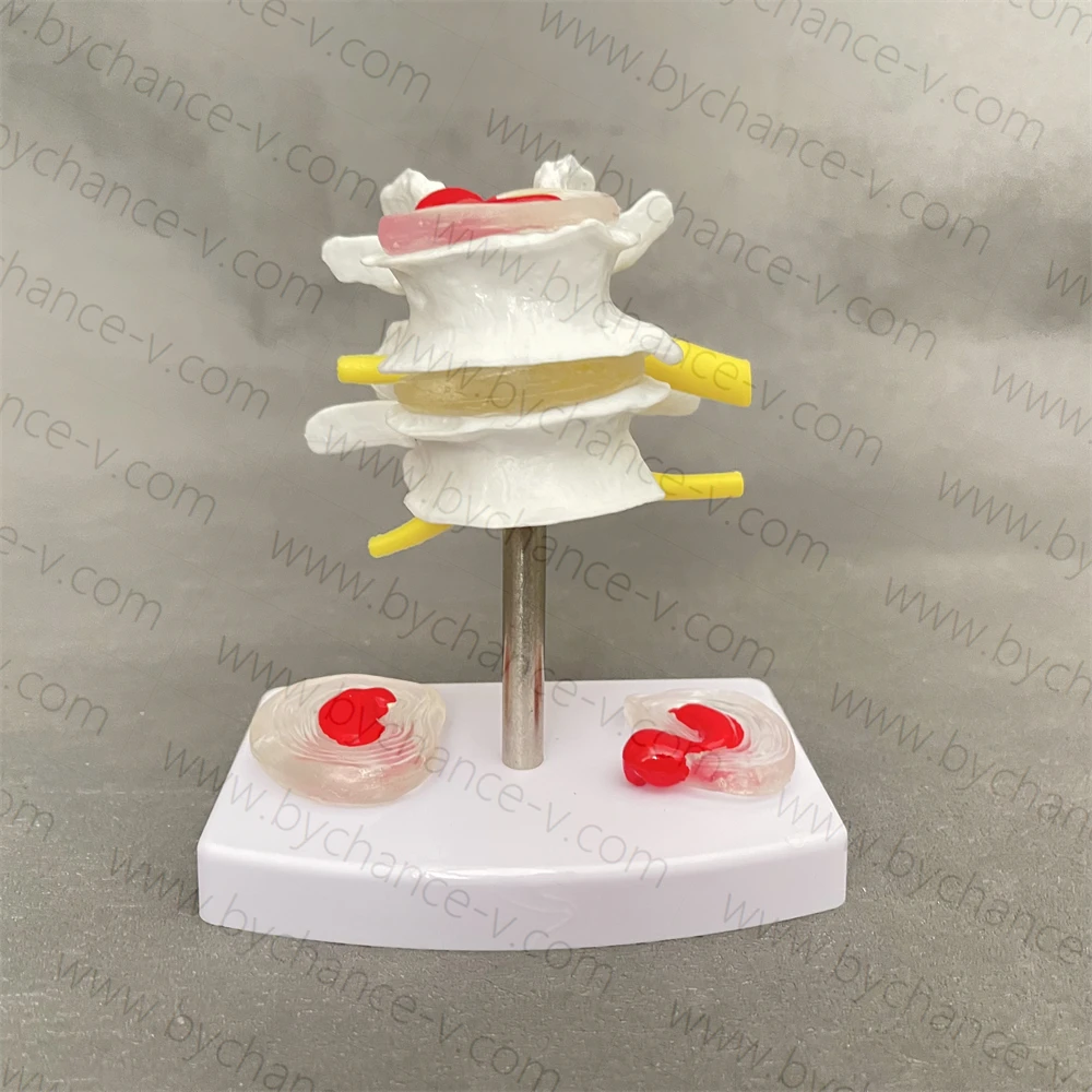 Pharmaceutical Factory Display Props Two-section Lumbar Spine Lesion ...