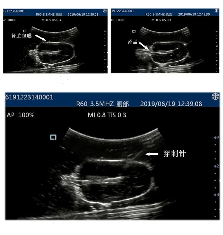 Ultrasound Guided Renal Puncture Model for Medical Training