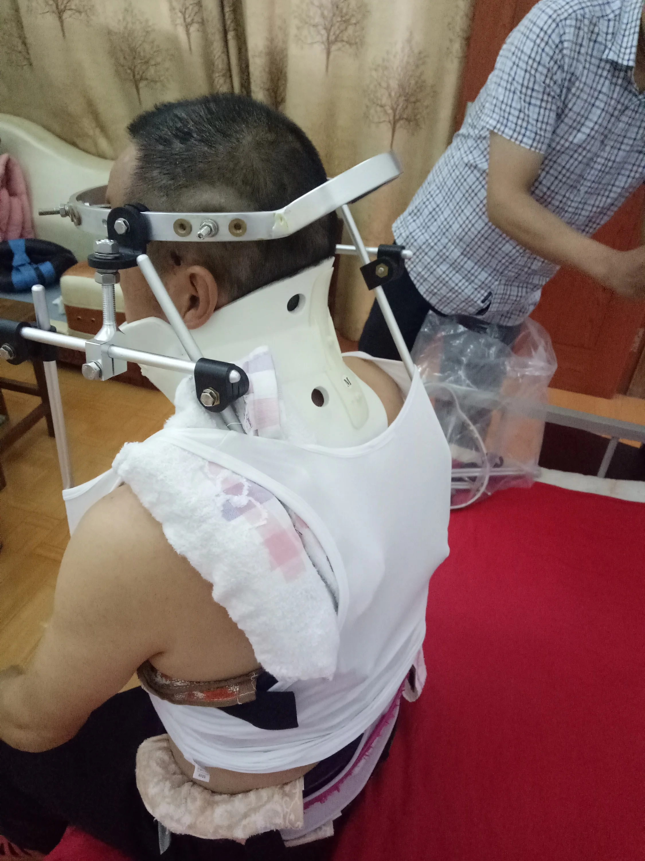 Halo Vest Clamp for Cervical Spine Recovery - CE Certified Medical ...
