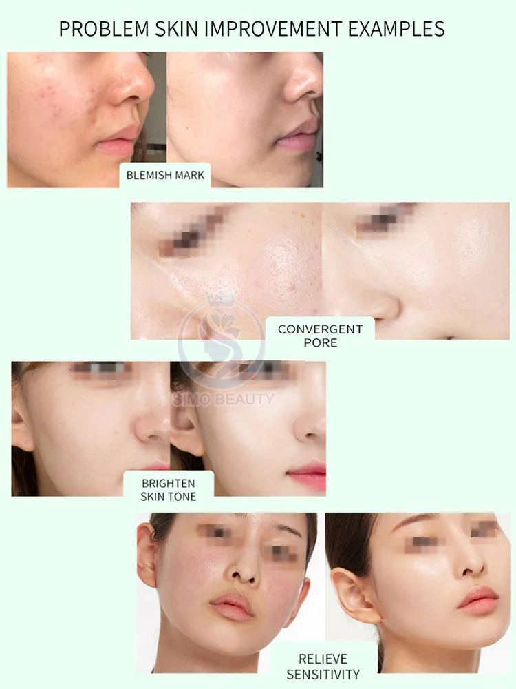 Skin Whitening Biomicroneedling Microneedl Algae Spicule Green Face ...