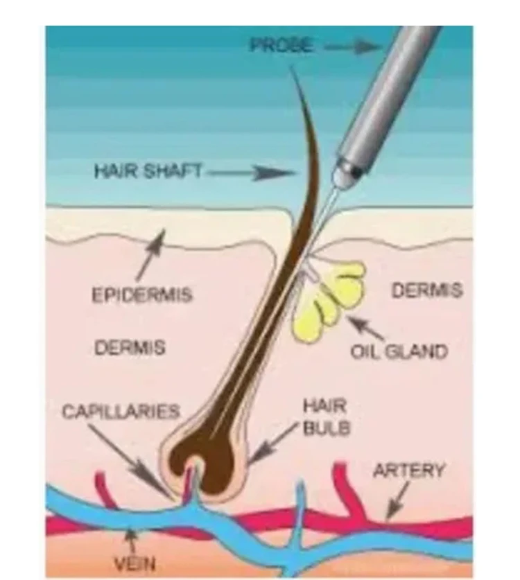 Permanent Electrolysis Hair Removal Device for Spider Vein Skin Tag ...