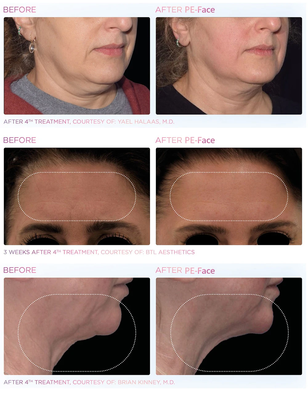 2023 Skin Care Massager Microcurrent Electric V Face Lifting Magnetic ...