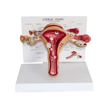 Pathological Model Of Ovarian Uterus Reproductive Medicine Gifts - Buy ...