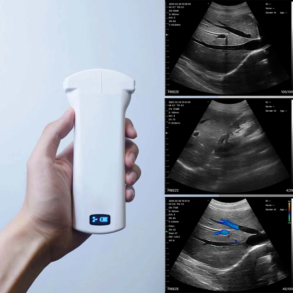 Suresult Konted Wireless Ultrasound Probe C10RL - WiFi iPhone ...