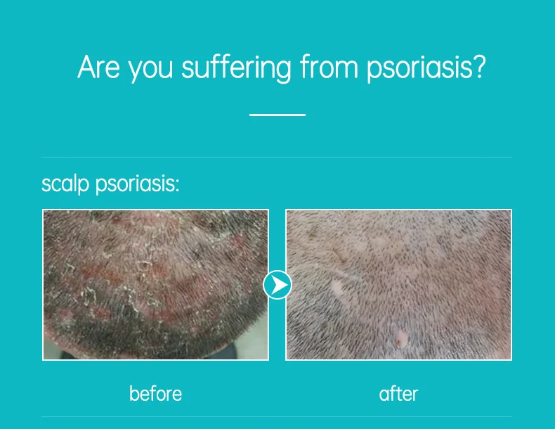 Skin Pruritus Ointment Skin Ringworm Wang Ointment Dispel Psoriasis ...