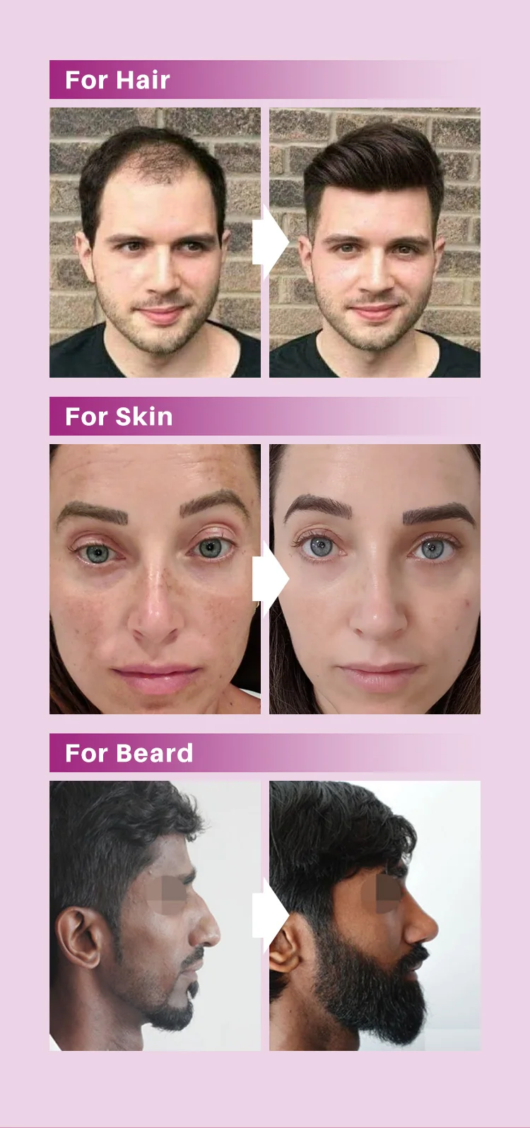 Brand New Microneedling Derma Roller 0.75mm 1.0mm Darma Roller ...