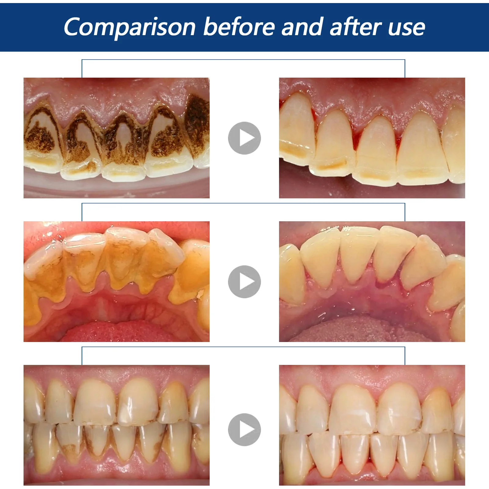 Jaysuing Dental Calculus Dissolving Oral Spray Bacteria Deodorant ...