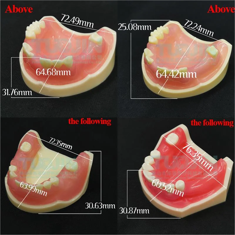 Dental Implant Models - TUOJIN for Teaching & Communication