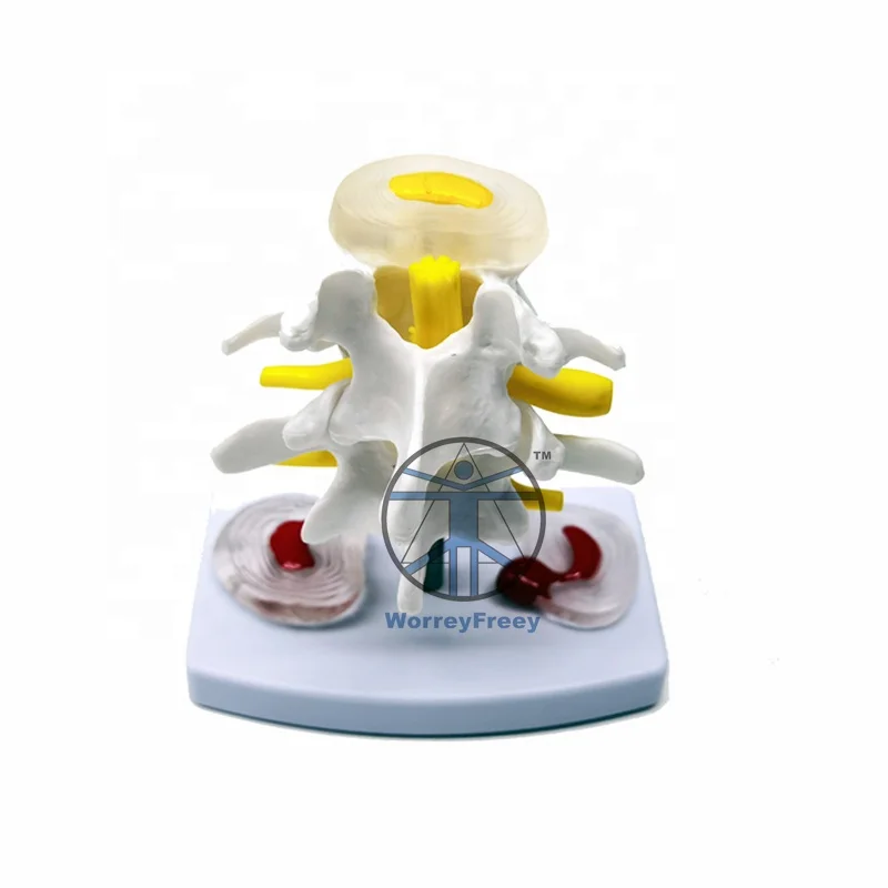 Medical Spine Endoscope Endoscopic Spine Surgery Teaching Model ...