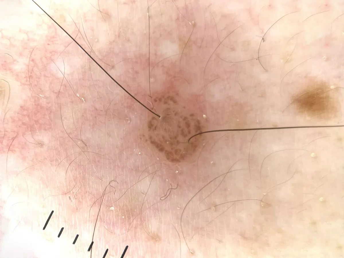 IBOOLO DE-400 Smartphone Polarized Dermatoscope - 10X Magnification