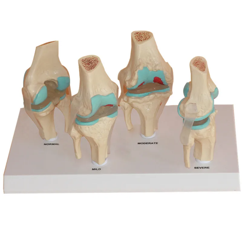 Human Anatomical Joint Disease Model Stage 4 Pathological Knee Joint ...