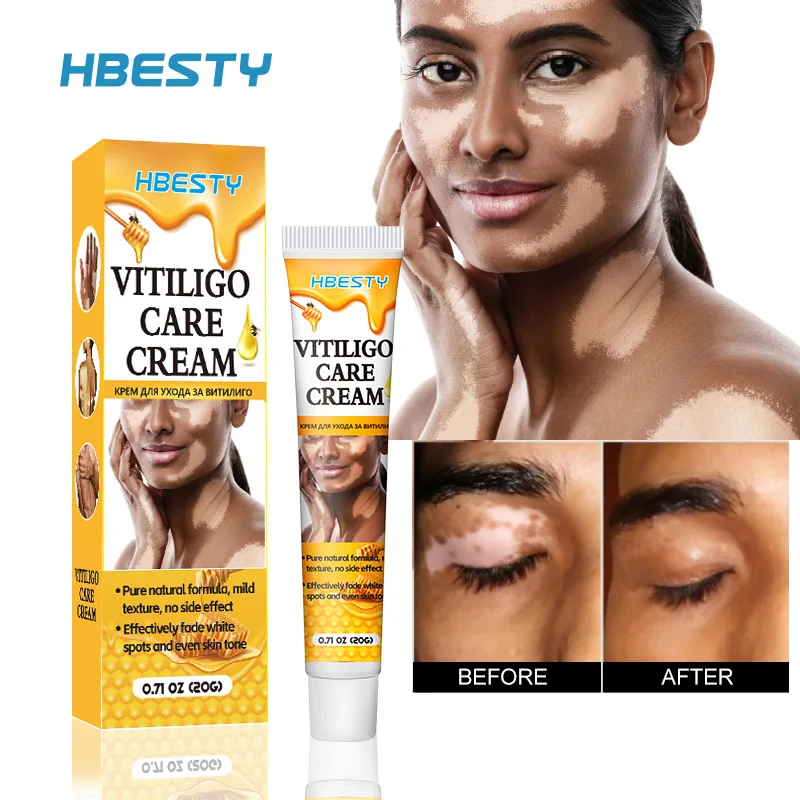 HBESTY Vitiligo Care Cream - Effectively Remove White Spots
