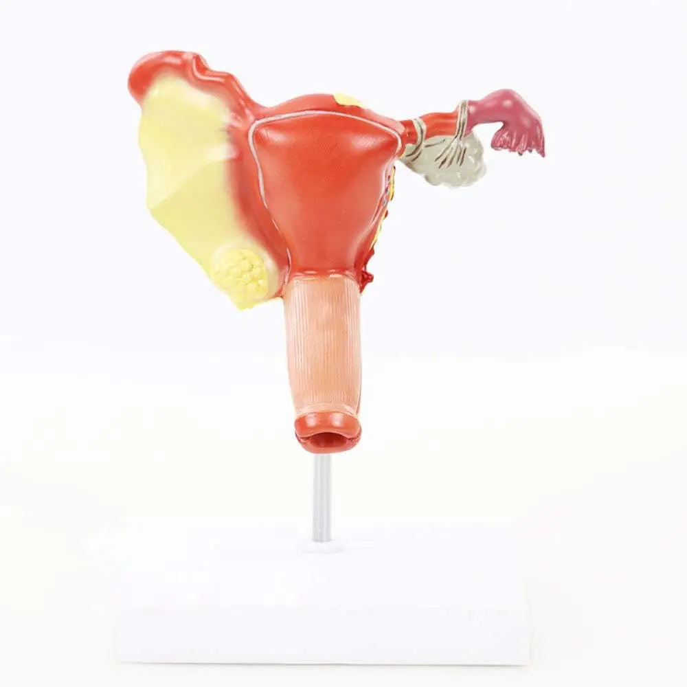 KyrenMed Pathological Model of the Female Genital Organs Human Uterus ...