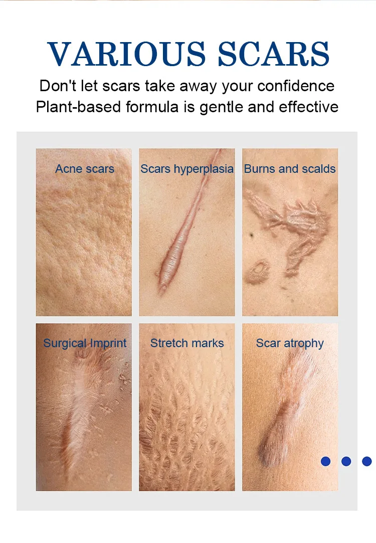 Strong Effective Acne Scar & Pimple Removal Face Gel Stretch Mark Tummy ...