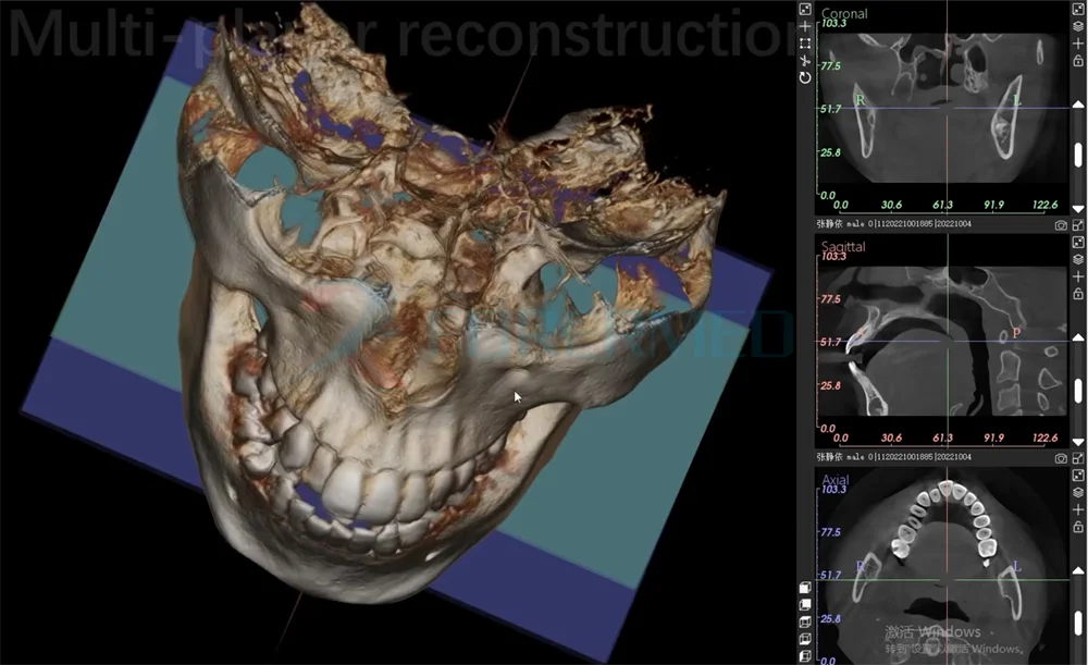 4 In 1 Digital Cbct Dental X Ray M2 Fov Cone Beam Ai Computed ...