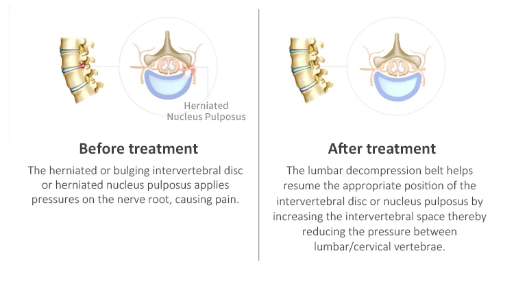 Alphay Lumbar Back Brace - Support and Relief for Pain