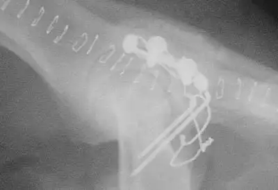 Titanium Anchors for Ligament Joint Repair - Durable Orthopedic ...