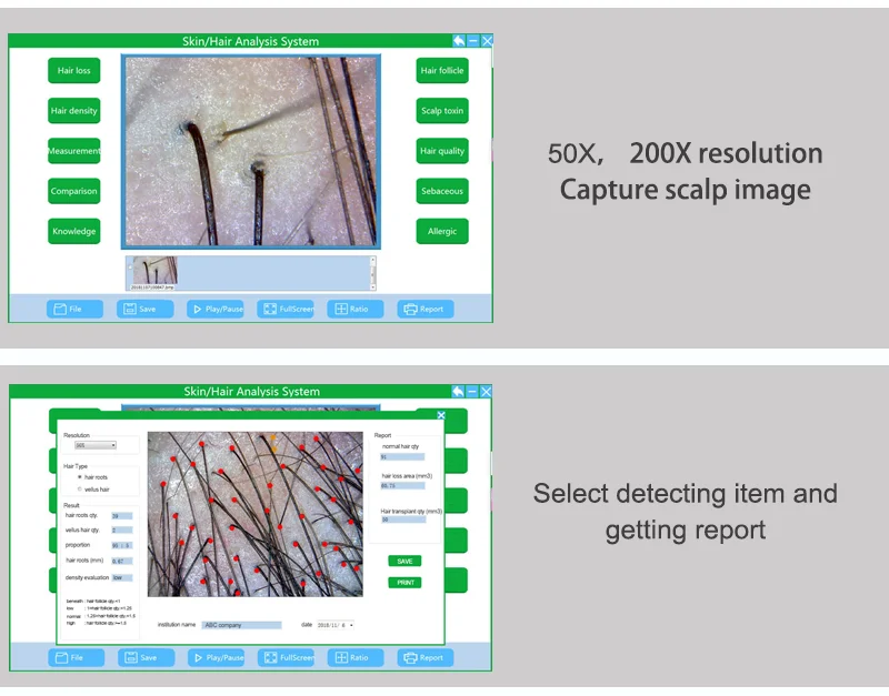 USB Hair Analysis Machine - Portable Scalp Health Tool