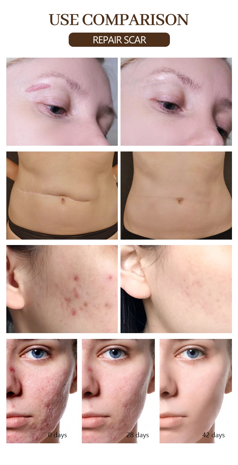 Fast Anti Acne Cream Anti Spots Treatment Scar Mark Removal Cream ...