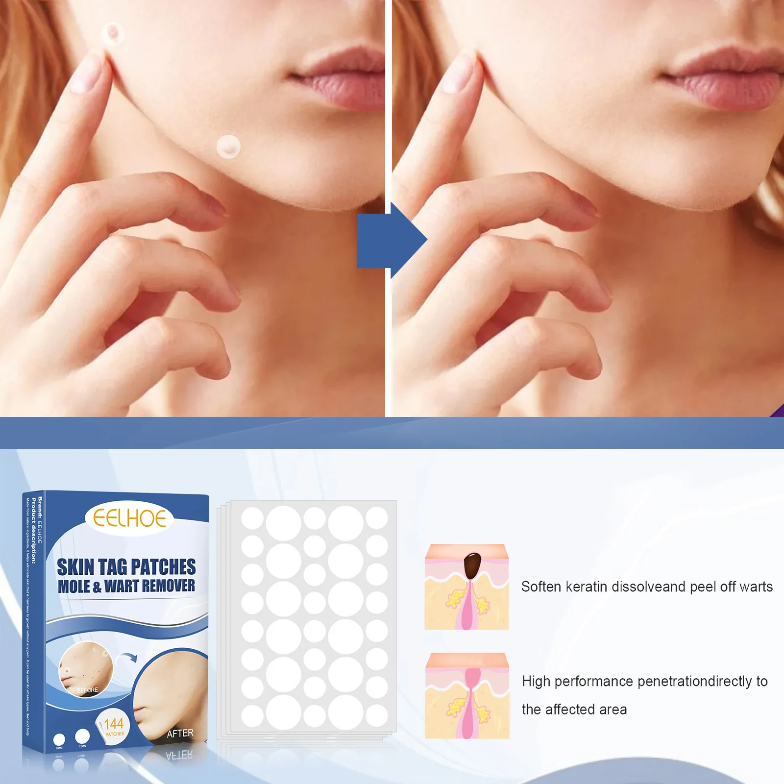 Skin Filamentous Calming Verruca Corns Patch Plantar Verruca Cure ...